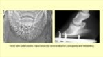 Pedal Osteitis (PO) - Etiology, Clinical Sign, Diagnosis & Treatment