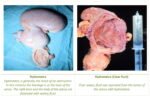 Mucometra or Hydrometra | Etiology, Pathogenesis & Treatment