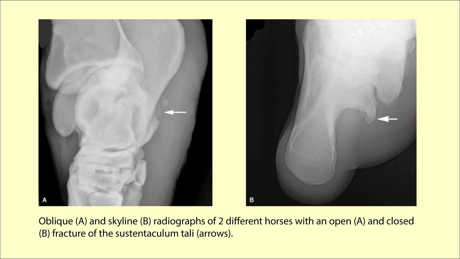 Sustentaculum Tali Calcaneus WikiSM (Sports Medicine Wiki)